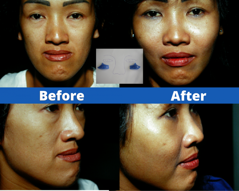 Cheek Implants - Dr. Oh Siew Leng, Danny